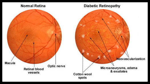 Retinopatia diabetica neproliferativa si proliferativa - Dr. Daniela ...